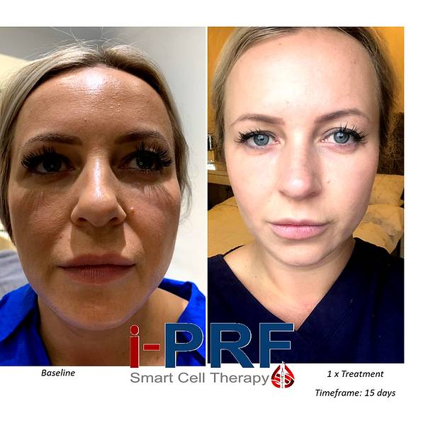 iPRF Platelet Rich Fibrin Training Courses UK | Cosmo Pro