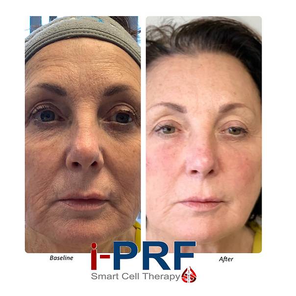 iPRF Platelet Rich Fibrin Training Courses UK | Cosmo Pro