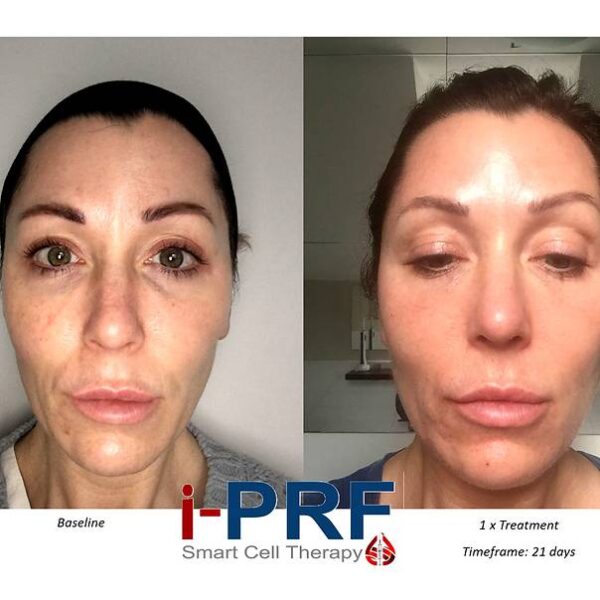 iPRF Platelet Rich Fibrin Training Courses UK | Cosmo Pro