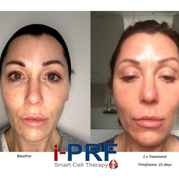 iPRF Platelet Rich Fibrin Training Courses UK | Cosmo Pro